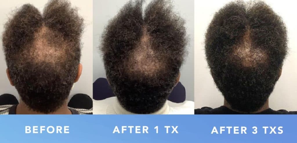 TED Hair Restoration in Memphis, TN | Royalty Wellness Spa